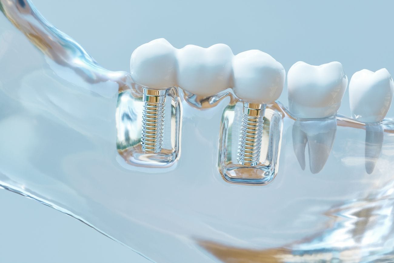 What Happens With Multiple Dental Implants | Dentist Rockville MD