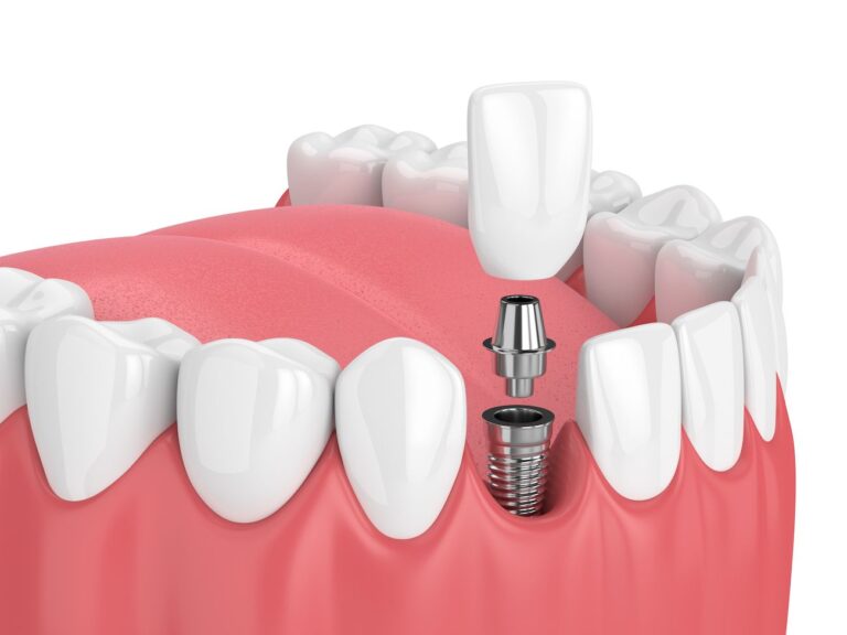 Know Your Dental Implant Fixture - Dentist in Rockville, MD